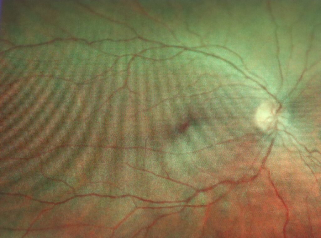 Optomap Retinal Scan - Gareth Roberts Opticians