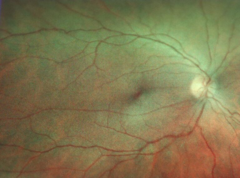 Optomap Retinal Scan - Gareth Roberts Opticians